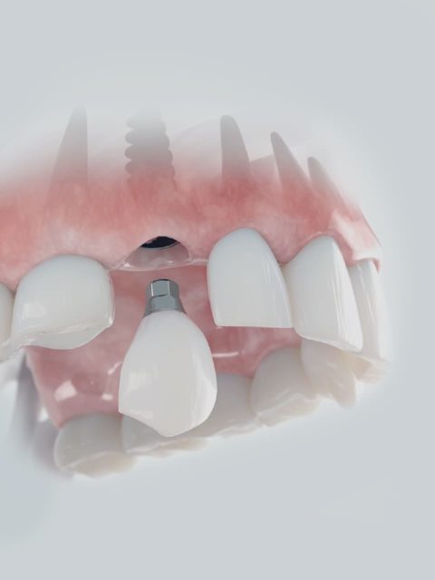 Pourquoi poser un implant dentaire